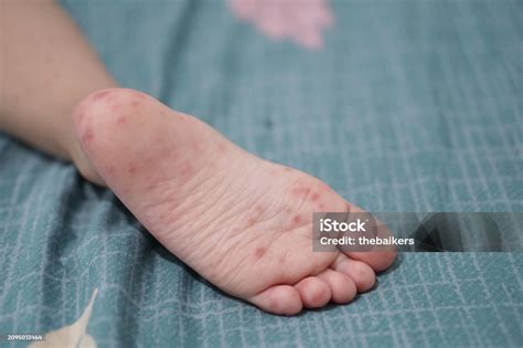 엔테로바이러스 또는 콕사키 바이러스에서 유래한 손 발 및 구강 질환 또는 Hfmd에 감염된 어린이의 발을 클로즈업하여 확대합니다 발에 대한 스톡 사진 및 기타 이미지