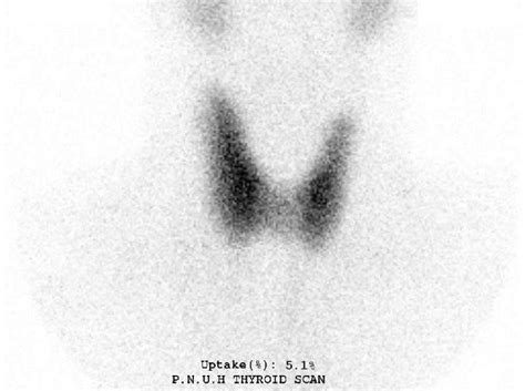 99 Mtc Thyroid Scan Shows A Mildly Enlarged Thyroid Gland With Download Scientific Diagram