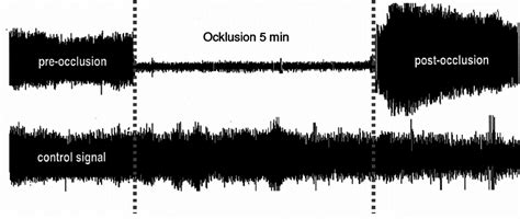 Reactive Hyperemia Peripheral Artery Tonometry Rh Pat Itamar Download Scientific Diagram