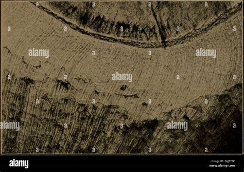 Interglobular Dentin
