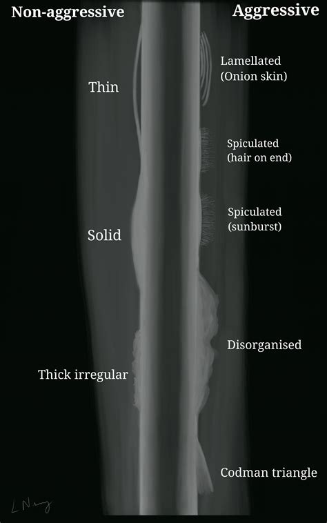 Periosteal Reaction Radiology At Ethel Montoya Blog