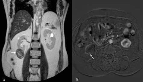 On The Coronal T2w Image Heterogeneous Exophytic Solid Renal Mass Is