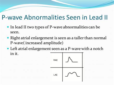 Advanced Ecg Interpretation Ppt Video Online Download