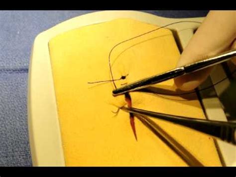 Cushing Pattern AVI YouTube