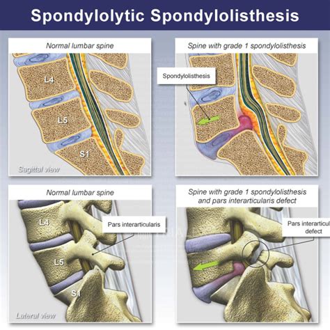 Spondylolytic Spondylolisthesis