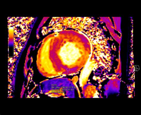 Left Ventricular Apical Aneurysm A Rare And Novel Phenotype In Fabry