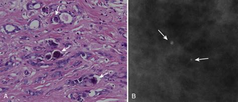 Mammographic Analysis Of Breast Calcifications Clinical Tree