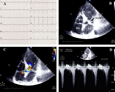 Panel A Electrocardiogram Depicting Nonspecific Repolarization
