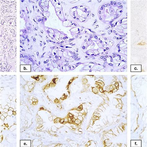 Intrahepatic Large Duct Cholangiocarcinoma The Lesion Has A Complex Download Scientific