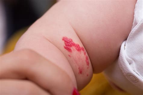 What Are Strawberry Hemangiomas In Newborn Infants
