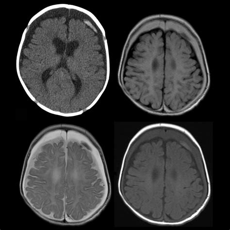 Pediatric Cerebral Atrophy Pediatric Radiology Reference Article