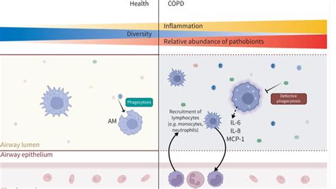 La Interacción Entre Macrófagos Y El Microbioma En La Enfermedad Pulmonar Obstructiva Crónica Epoc