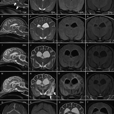 Analysis Of Cerebrospinal Fluid Csf Some Of Mononuclear Cells In Csf