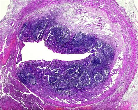 Acute Phlegmonous Appendicitis Photograph By Science Photo Library Pixels