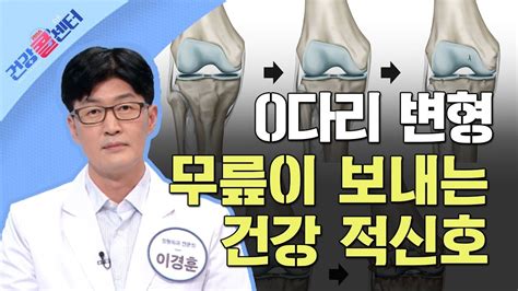 건강콜센터 O다리 변형 약물 치료 호전 없으면 인공관절 치환술 필요 Youtube