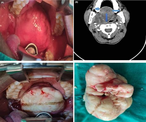 Photograph Of A Patient Displaying A Huge Soft Palate Mass A A