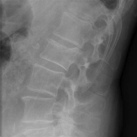 Lateral View Of A Patient With An Osteoporotic L Compression Fracture Download Scientific
