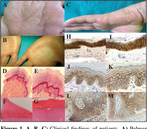 Aberrant Expression Of Aquaporin 3 In Hereditary Papulotranslucent