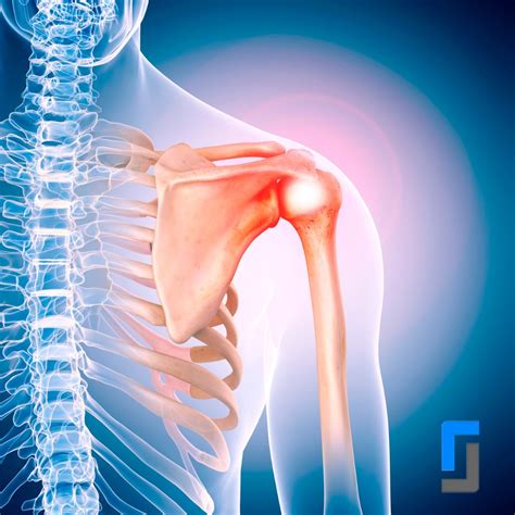 Impingement Syndrome Can Range From Simple Bursitis To A Tearing Of The