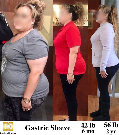 Gastric Bypass Results Before And After