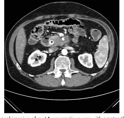 Figure 1 From Advances In The Surgical Management Of Resectable And Borderline Resectable