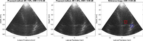 Figure 1 From A Low Rank And Joint Sparse Model For Ultrasound Signal