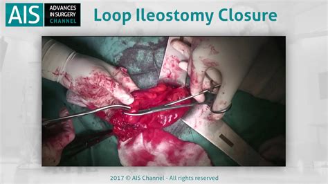 Loop Ileostomy Closure