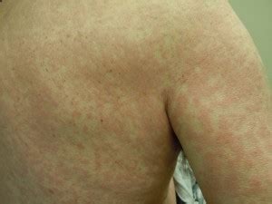 Drug Allergy Medication Allergy