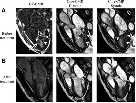 Biopsy Proven Loeffler Endocarditis Successfully Treated With Steroids