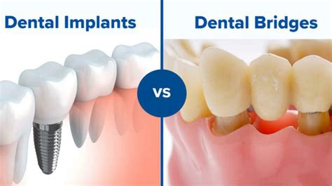 Dental Implants Vs Dental Bridges Missing Teeth Replacement