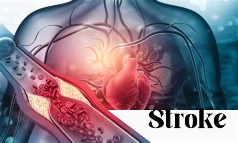 Elective Surgery Within 1 Year Of An Acs Or Stroke Associated With Increased Postoperative