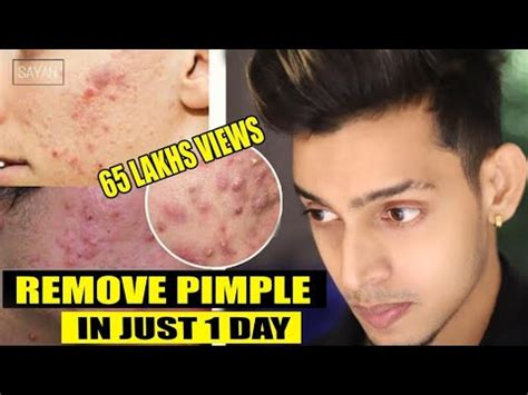 How To Remove Pimples And Dark Spot In Just 1 Day HINDI Skin Care Tips For Men YouTube