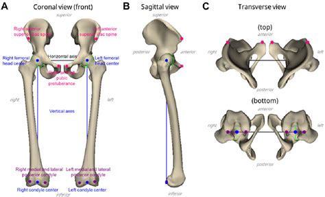 Figure 1 From Quantification Of Acetabular Coverage On 3 Dimensional Reconstructed Computed