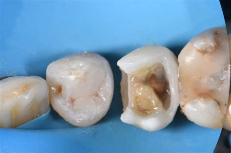 matrix in matrix assembly for complex dental fillings matrix in matrix