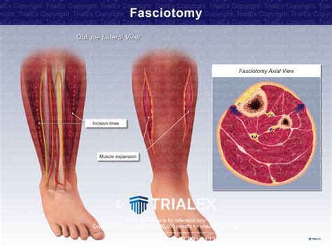Fasciotomy Trialquest Inc