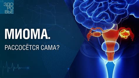 Миома. Рассосётся сама? На здоровье 02.07.2022 - YouTube