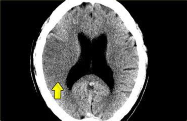 The Radiology Assistant Imaging In Acute Stroke