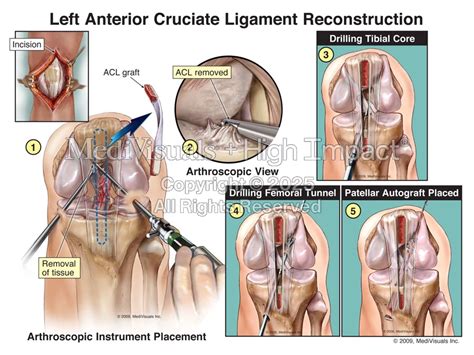 Left Anterior Cruciate Ligament Reconstruction Medivisuals High Impact