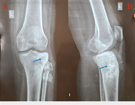 Figure 3 From Diaphyseal Tibial Osteosarcoma With Myiasis Semantic