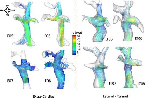 Figure 5 From Visualization Of Flow Structures In Fontan Patients Using