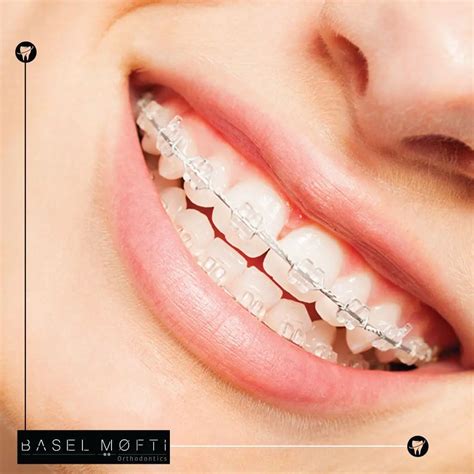 Ceramic Braces In Dubai Dr Basel Mofti Orthodontist