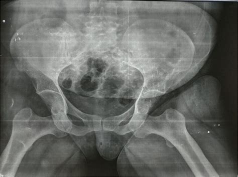 X Ray Pelvis Ap View Shows Simultaneous Anterior Dislocation Of Download Scientific Diagram