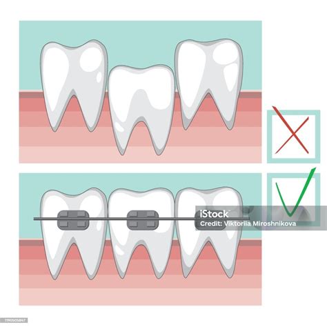 건강한 잇몸에 중괄호가있는 벡터 치아 치열 교정 의사를위한 대구치가있는 건강한 물린 개념 개념에 대한 스톡 벡터 아트 및 기타 이미지 개념 개선 건강관리와 의술