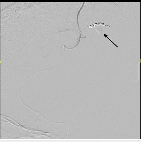 Dsa After Embolization Download Scientific Diagram