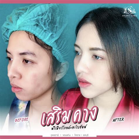 รีวิวเสริมคางพรีเมียมโกลด์ ตะไบปรับฐาน คางสวยได้รูปขึ้นมากๆค่ะ ช่วยให้ใบหน้าดูเรียวยาวขึ้น