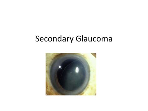 Secondary Glaucoma Final Pptx