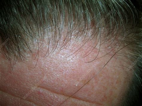 Seborrheic Dermatitis Stock Image C056 5160 Science Photo Library