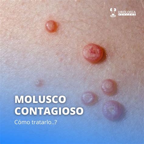 Tratamiento Del Molusco Contagioso Urología Peruana Dr Susaníbar