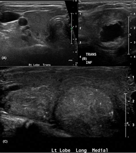 A Right Mid Thyroid Lobe Transverse View B Left Inferior Thyroid Download Scientific Diagram