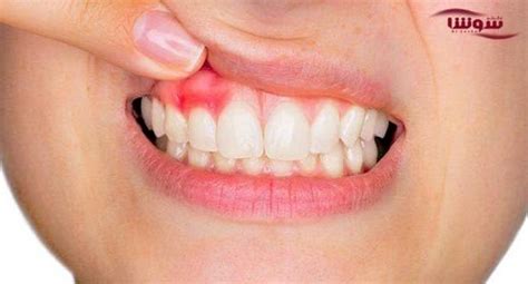 تورم و قرمزی لثه را چگونه درمان کنیم؟